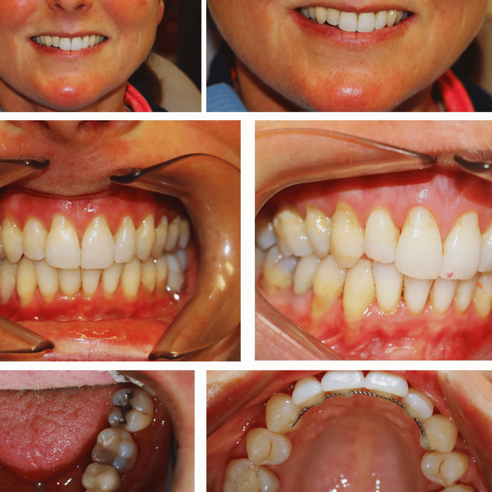 Case 1 - Implants & Invisalign - Merrow Park Dental | Dentist in ...