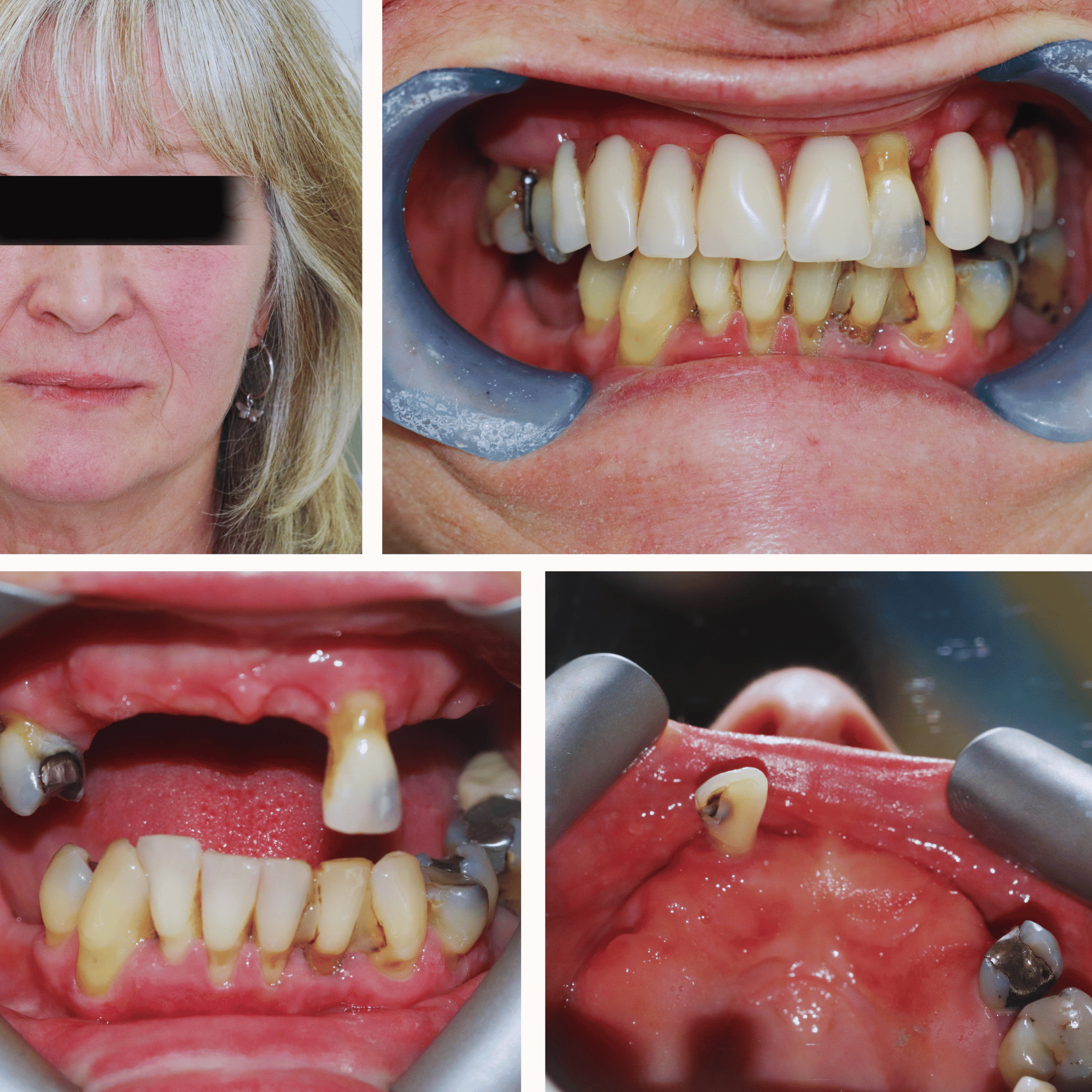 Case 1 - Full Arch Implants - Merrow Park Dental | Dentist in Guildford ...