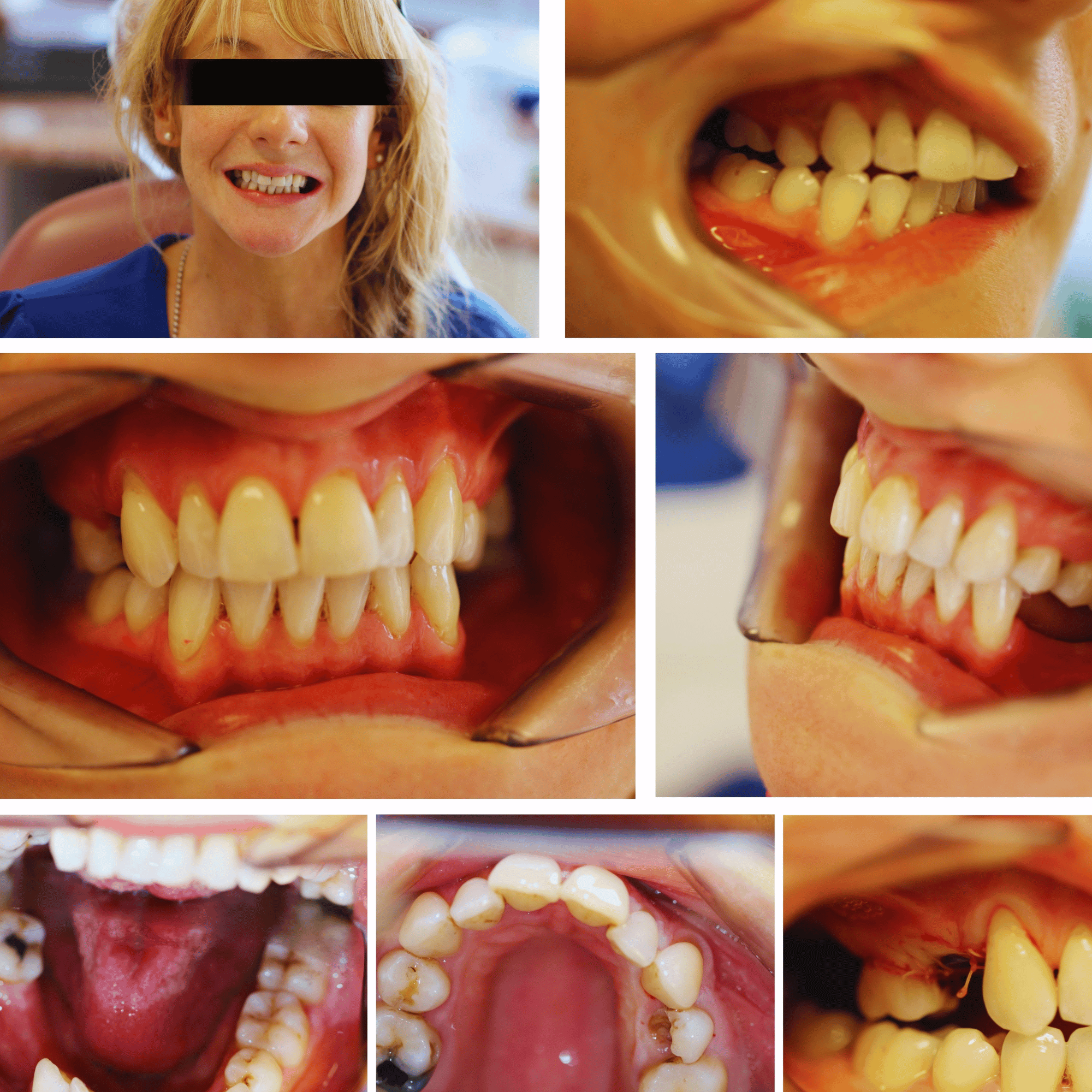 Case 2 - Veneers - Merrow Park Dental | Dentist in Guildford, Surrey